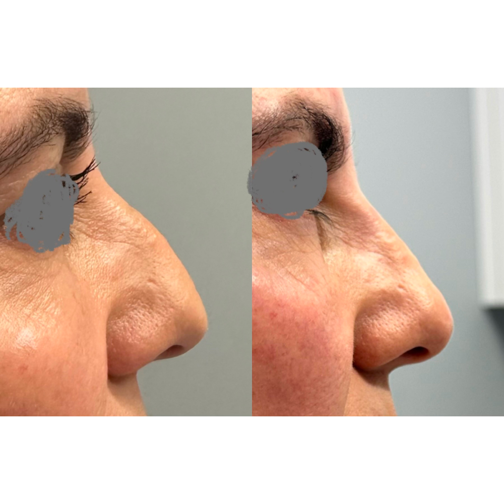 Liquid Rhinoplasty Newtown | Rejuvenation Medical Aesthetics